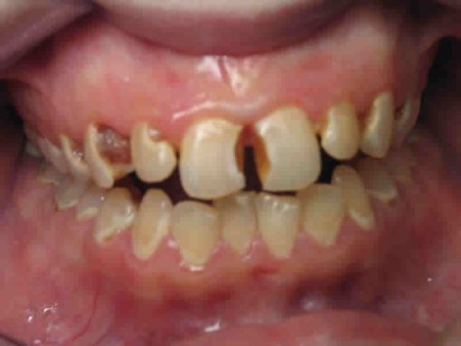 tooth erosion - Do Gooder